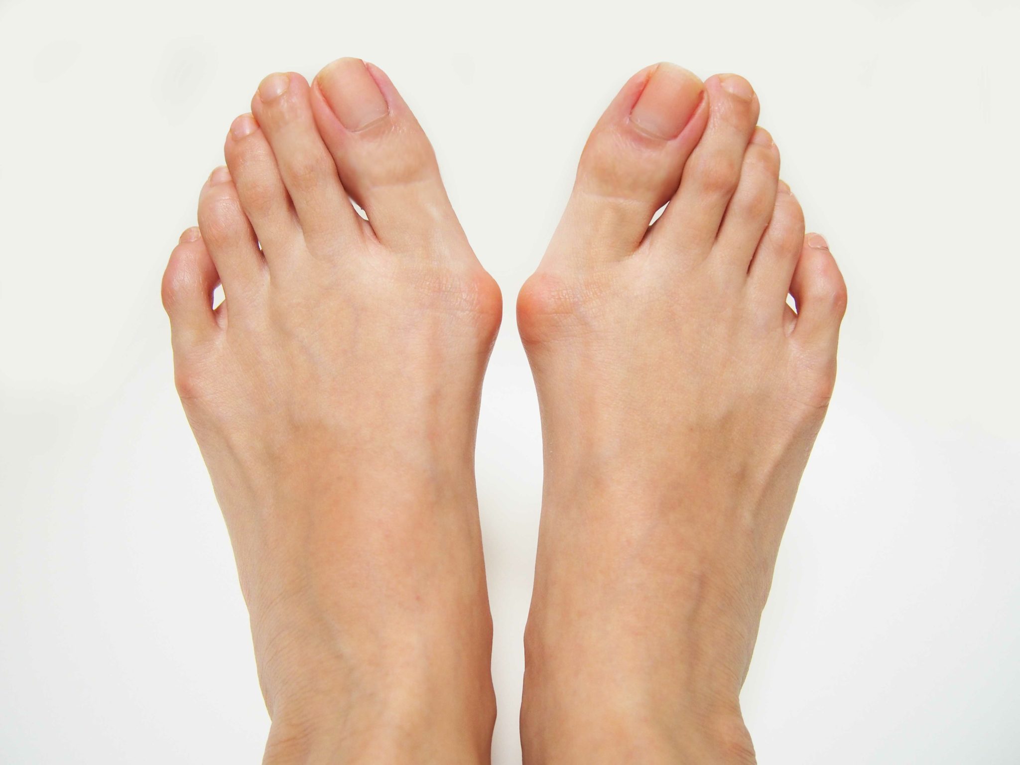 Bunions: Hallux Abducto Valgus (HAV) - Marie Whitfield Podiatry